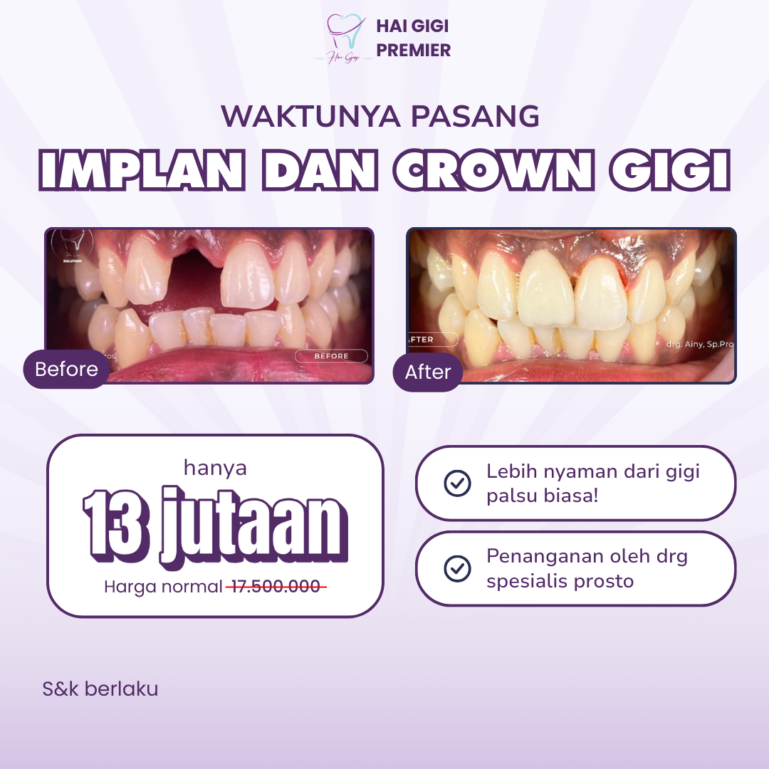 Promo Implan Gigi