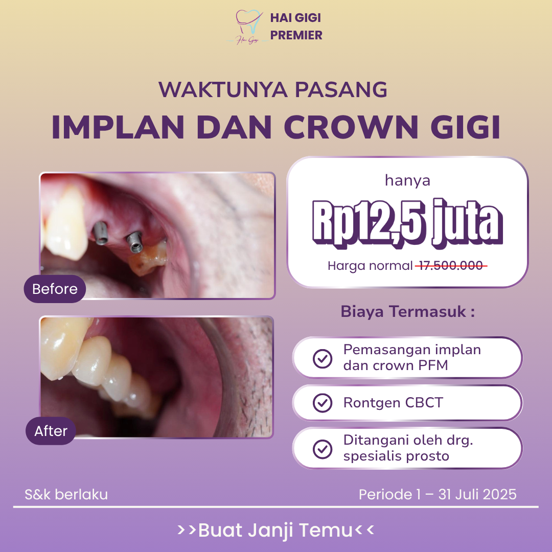 Paket Implan dan Crown Gigi - Hai Gigi Premier