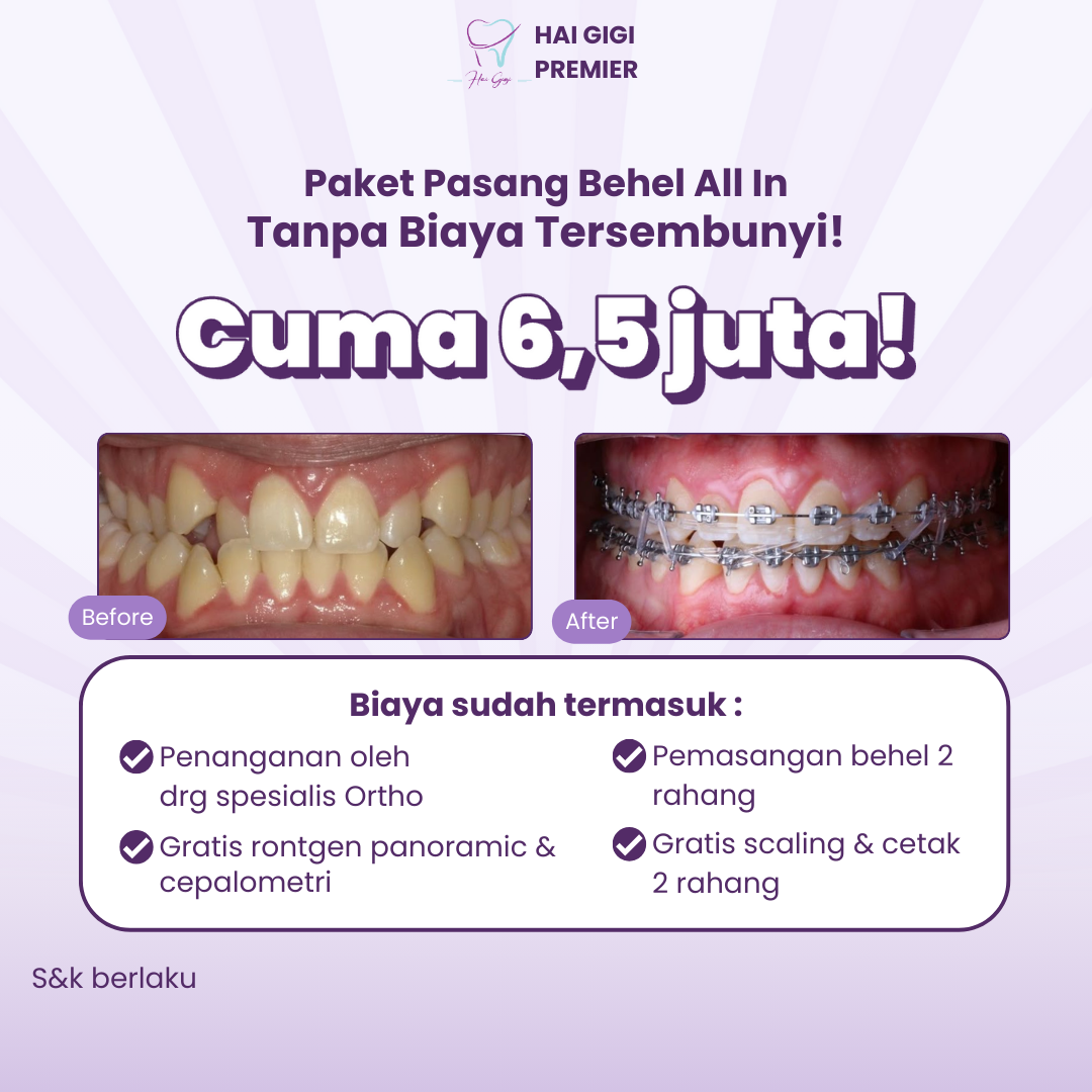 Promo Paket Behel Lengkap - Hai Gigi Premier