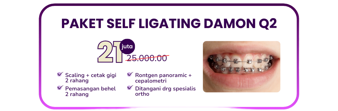 Paket Behel Self Ligating Damon Q2
